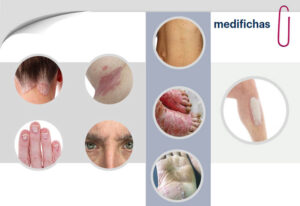 Tipos de psoriasis | AlmirallMED