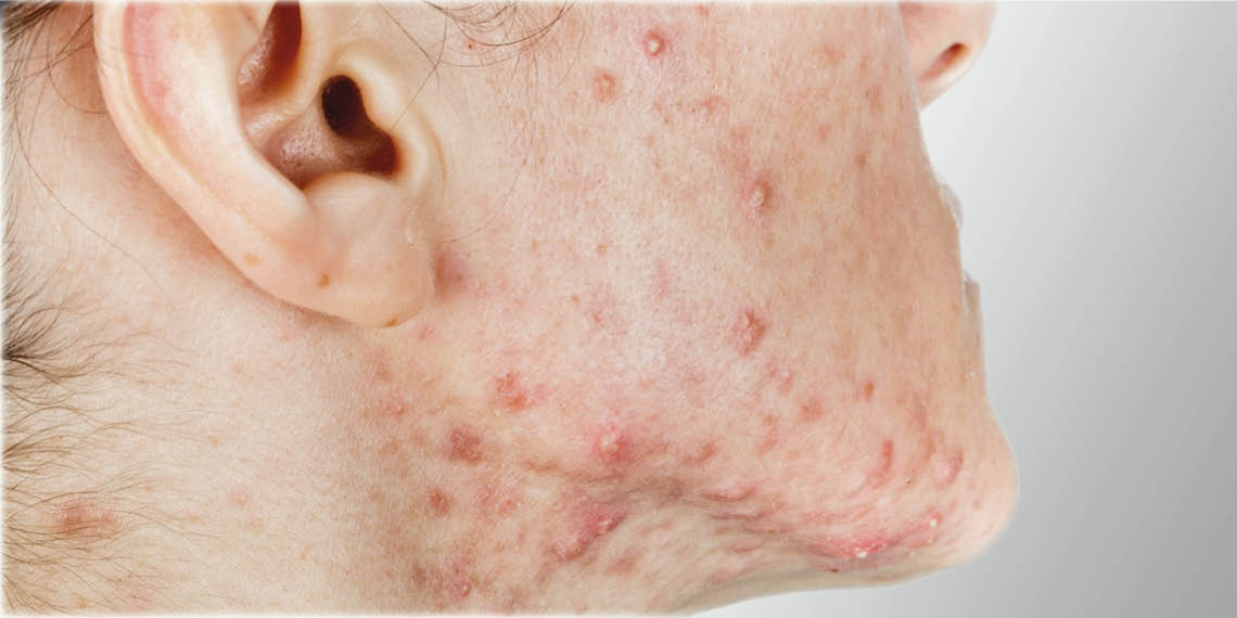 Almirall recibe la aprobación de la FDA para producir Seysara ...