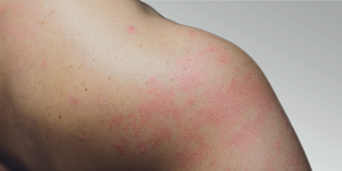 Atopic dermatitis – Atención Primaria