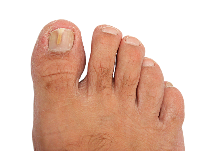 Todo sobre... la onicomicosis - Atención Primaria