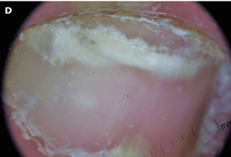 Revisión sistemática de la dermatoscopia en la onicomicosis