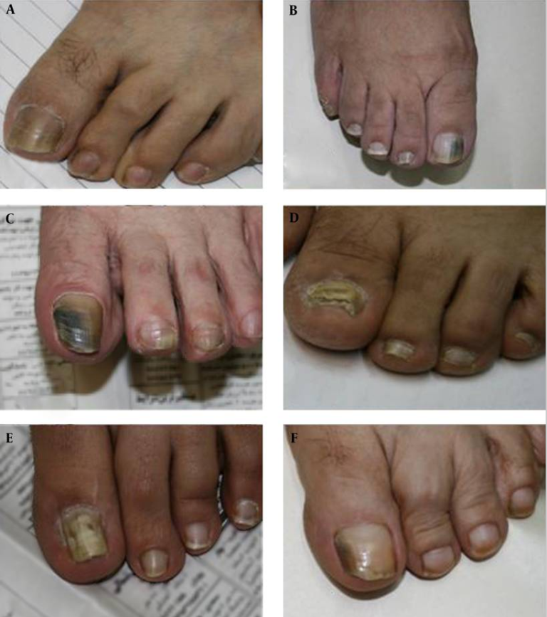 Onicomicosis por hongos no dermatofíticos